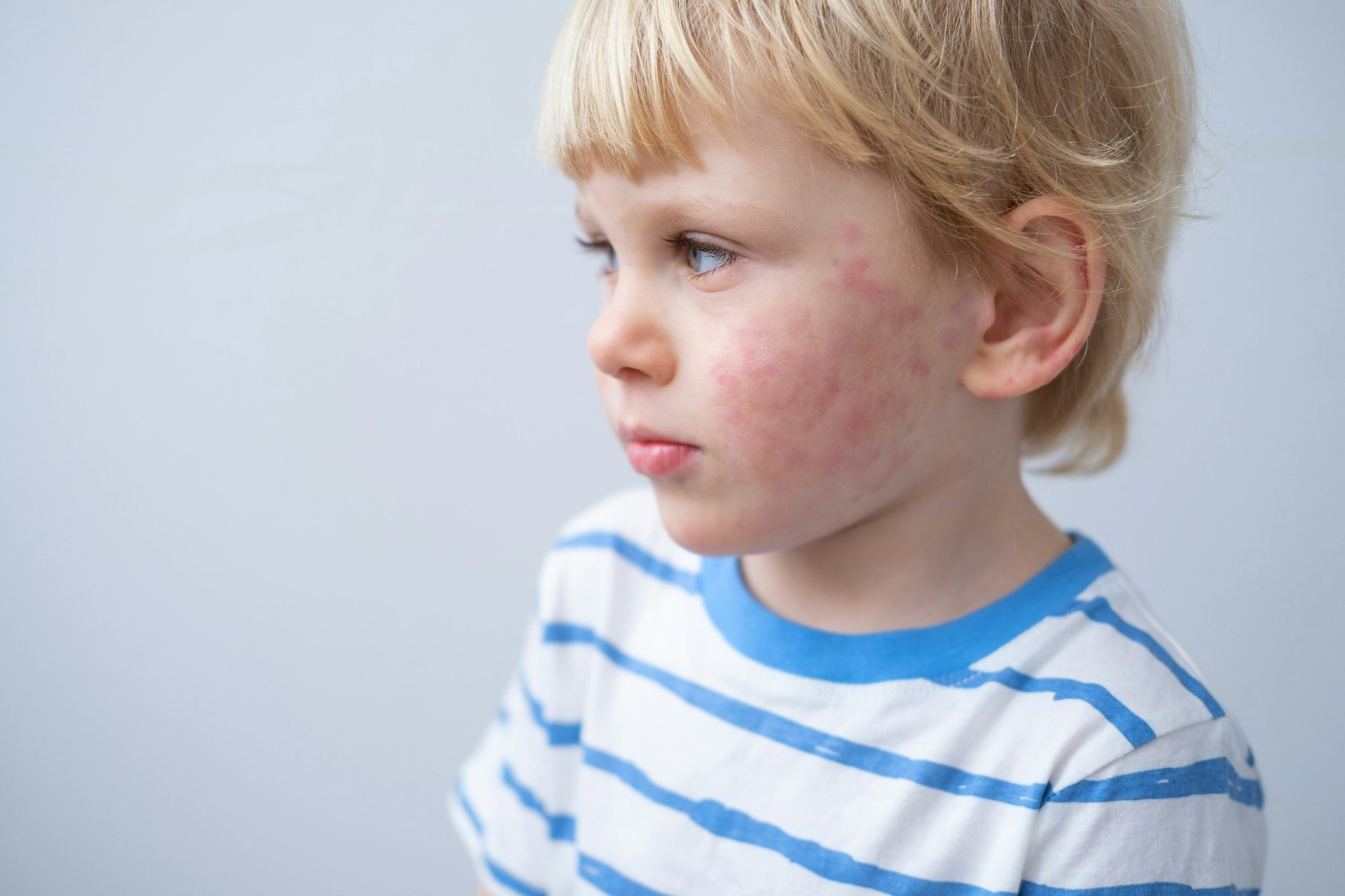 Plaque eczema : remèdes naturels pour apaiser votre peau - Cancerologie ...